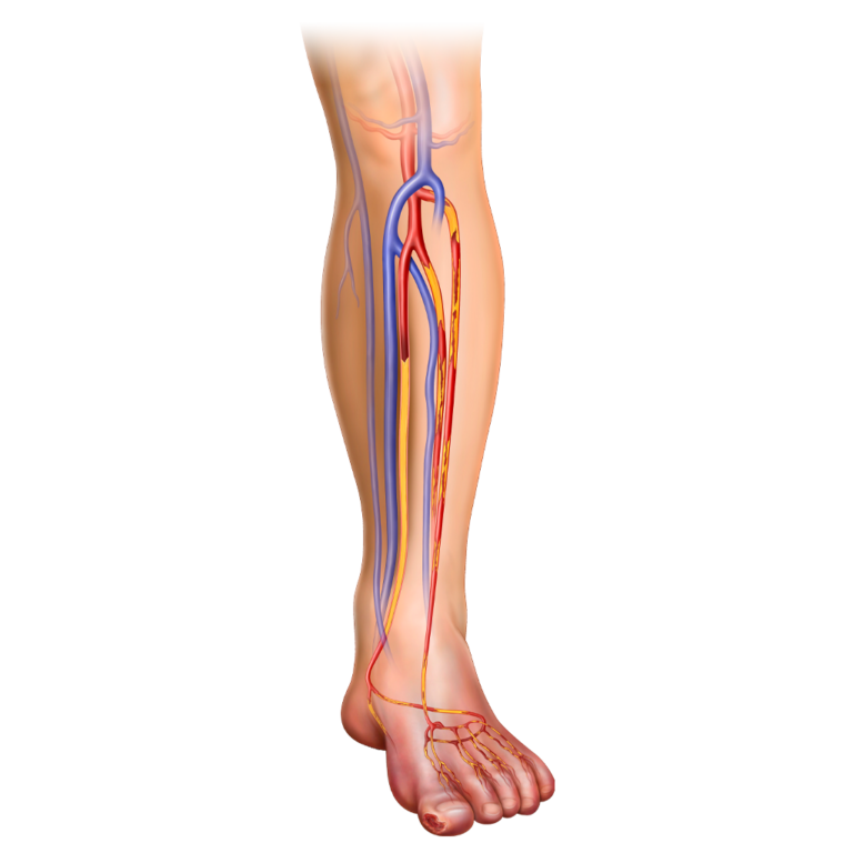 Hear from LimFlow Patients and Physicians - LimFlow