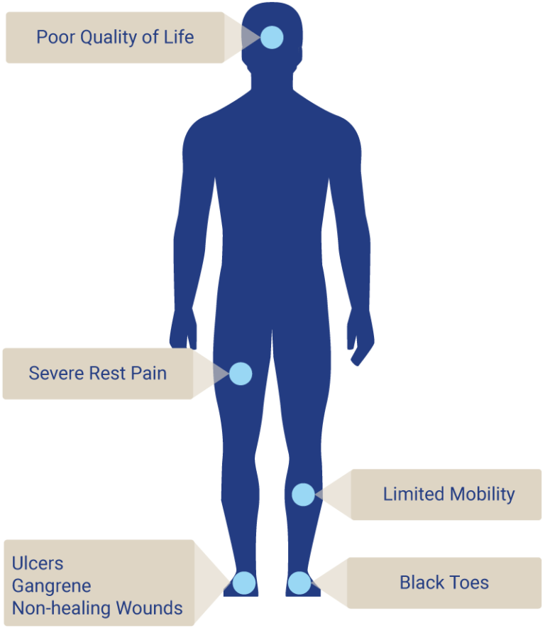 CLTI Treatment Candidate - LimFlow