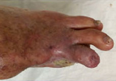 First-in-Human LimFlow Studies - LimFlow