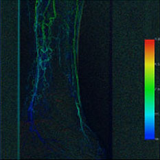 First-in-Human LimFlow Studies - LimFlow