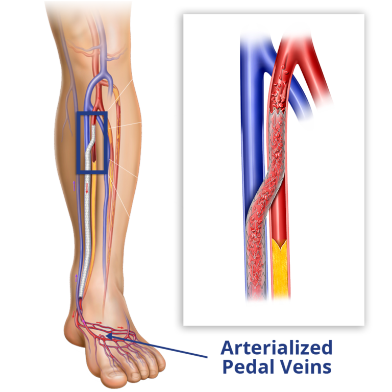 Patients Living with PAD - LimFlow